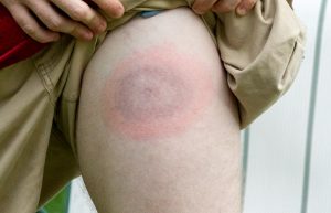 Can Lyme Disease Be Cured? - Know More In Details